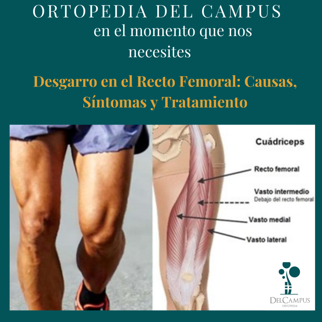 Desgarro en el Recto Femoral: Causas, Síntomas y Tratamiento - Del ...